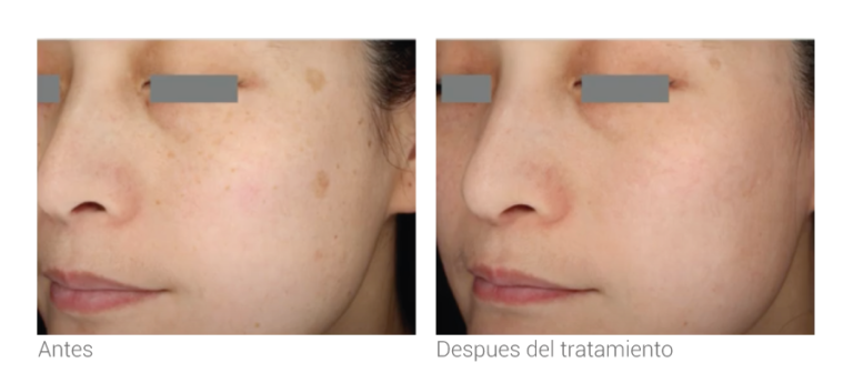 Eliminación De Manchas Faciales O Léntigos Con Láser 965 140 460
